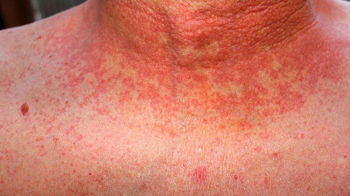 bệnh ban đỏ Tiếng Anh là gì